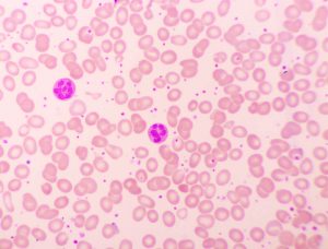 A QUICK LOOK AT THE CAUSES AND SYMPTOMS OF THROMBOCYTOPENIA